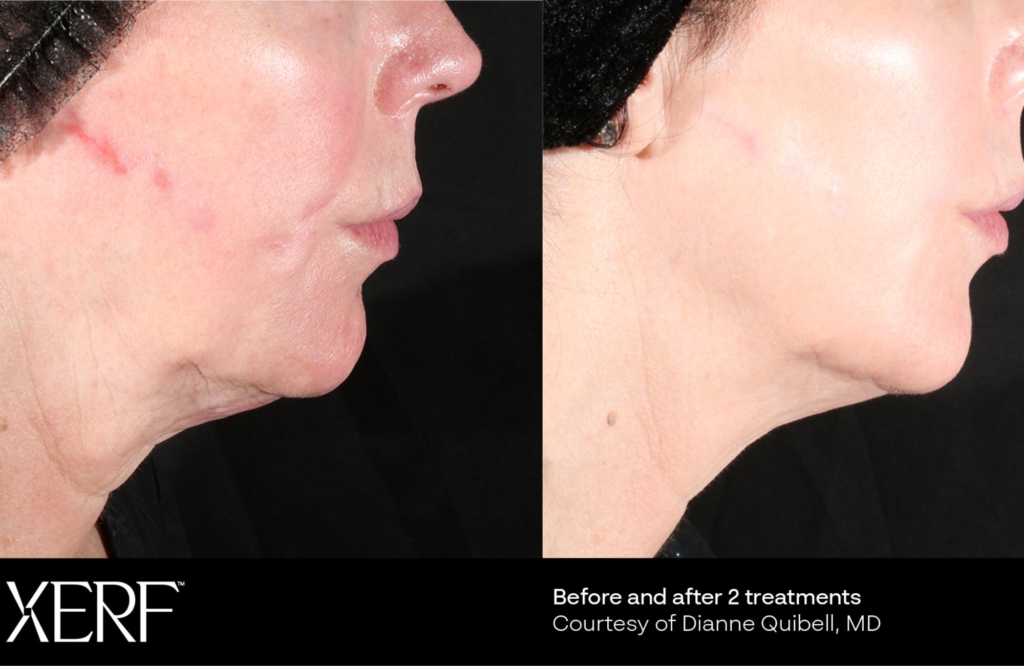 This Popular Skin-Tightening Procedure In South Korea Is Now Available ...